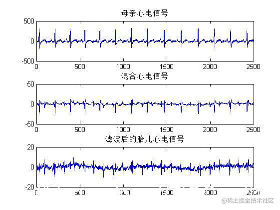 Extraction of fetal ecg signals based on matlab LMS adaptive filtering ...