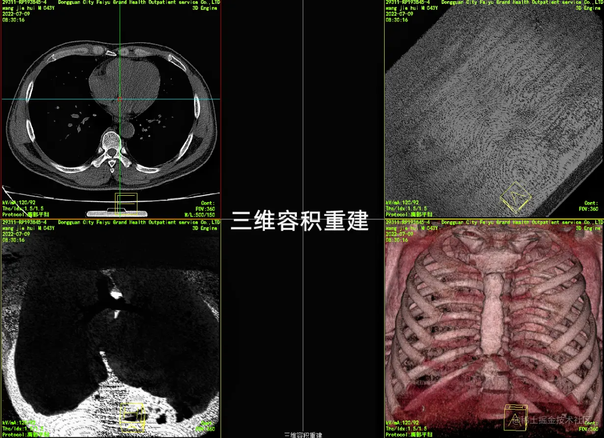 【C++医学影像PACS】CT检查中的三维重建技术【影像科普】CT检查中的三维重建是什么检查？ 一、【PACS影像科普】 - 掘金